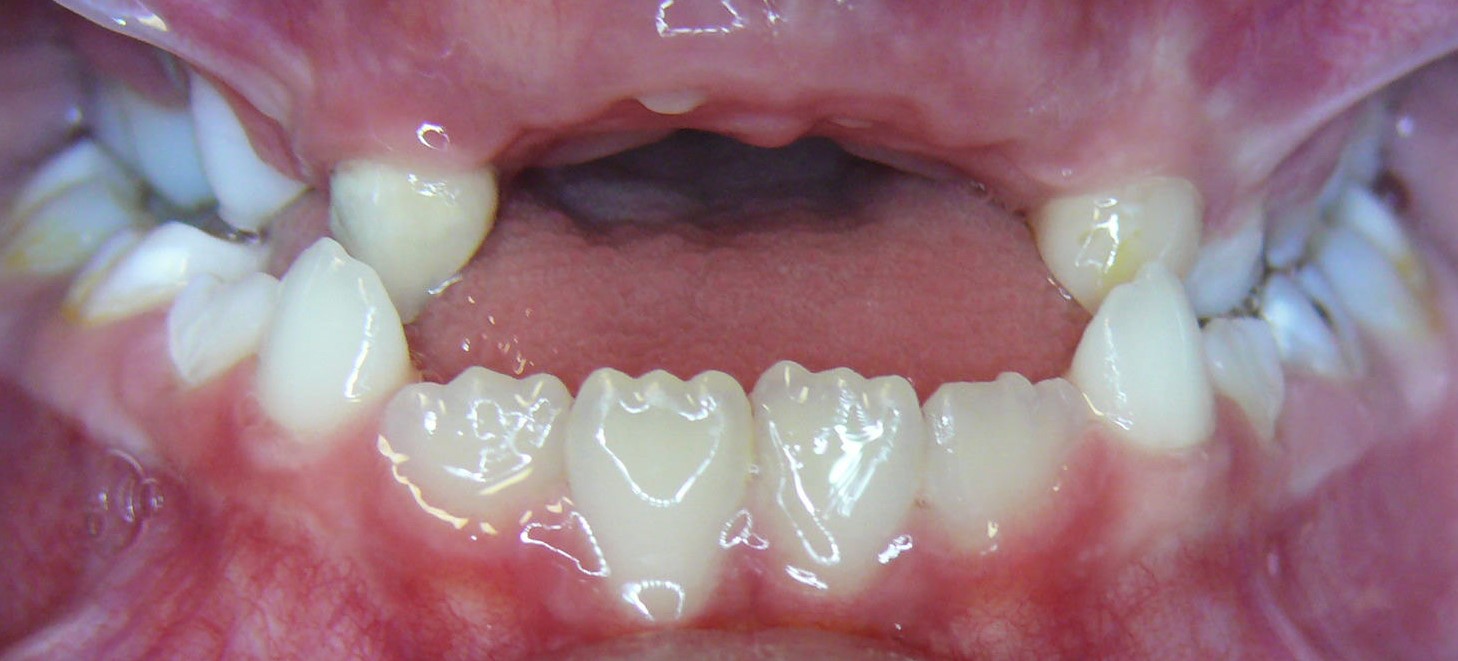 Kieferorthopädische Frühbehandlung | Kieferorthopäde Stadthagen Dr. Nessler