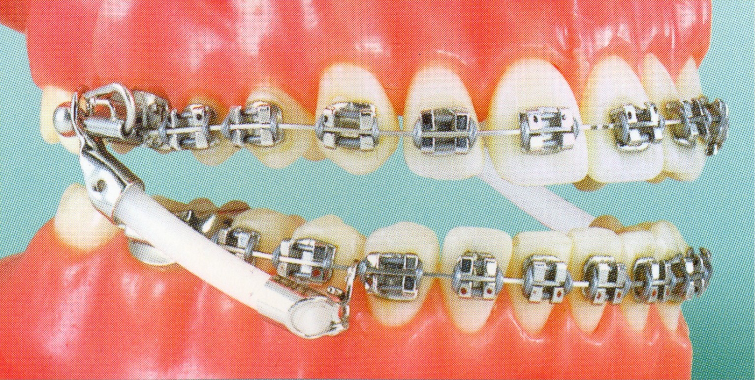 Sabbagh, Jasper-Jumper und Federgelenk nach Fränkel | Kieferorthopäde ...